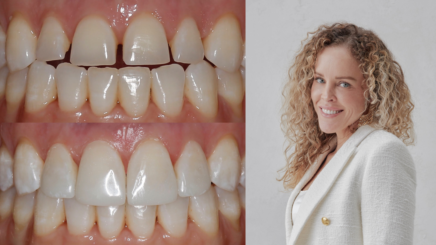 Digitally Assisted Anterior Composite Restorations