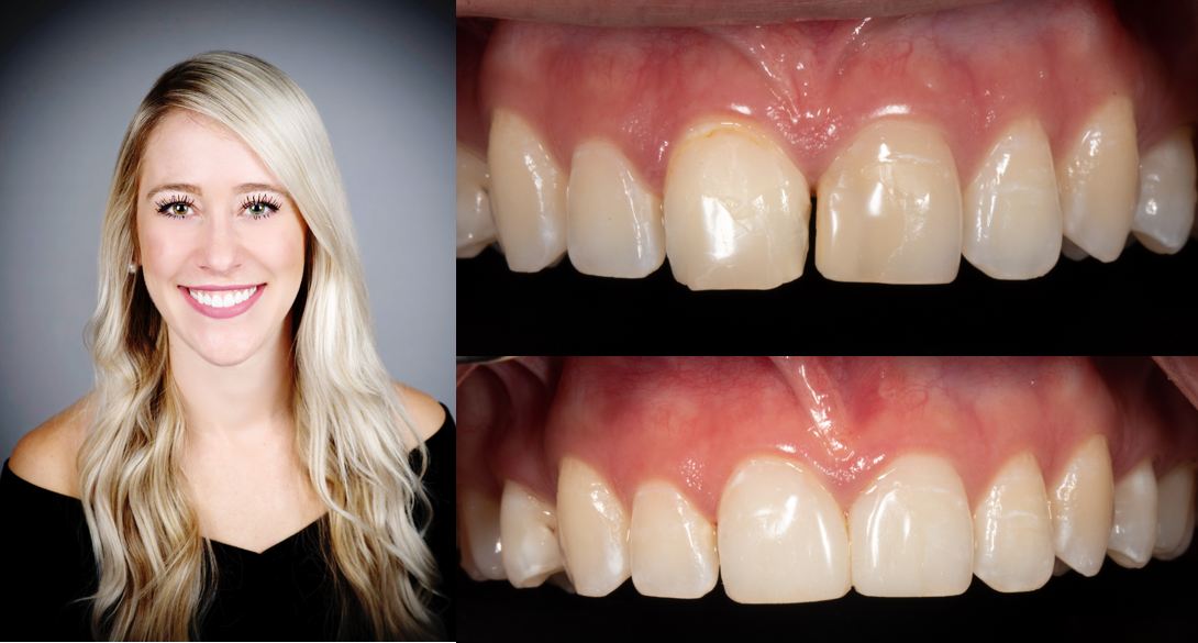 Free Webinar: Composites for Diastema Closure - Melissa Seibert, DMD